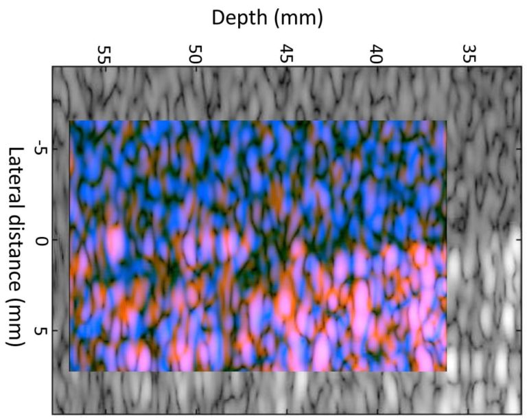 Breakthrough adds new color to ultrasound