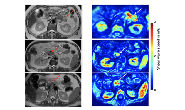 New imaging technology could buy time for pancreatic cancer patients