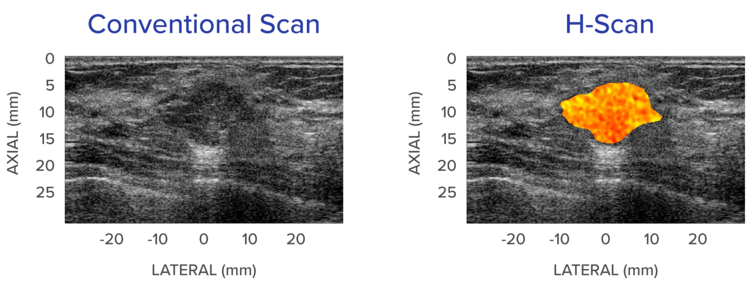 Patented ultrasound technologies improve diagnosis for cancer and other ...